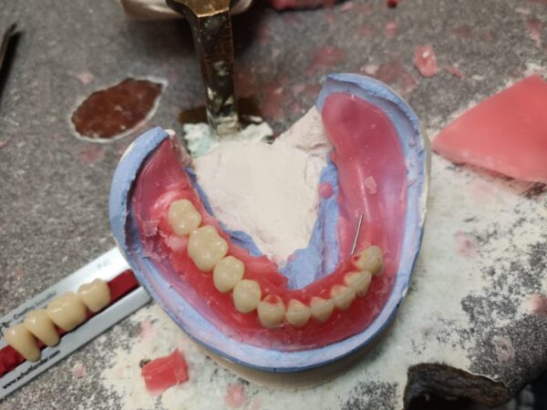 How is a denture made? | Halesowen Dental