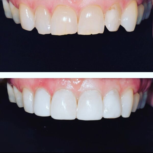 The Ultimate FAQ Guide to Composite Bonding | Halesowen Dental