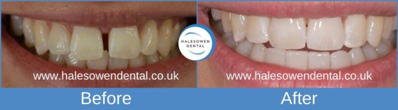 Composite Teeth Bonding & Composite Resin Bonding Halesowen Dental